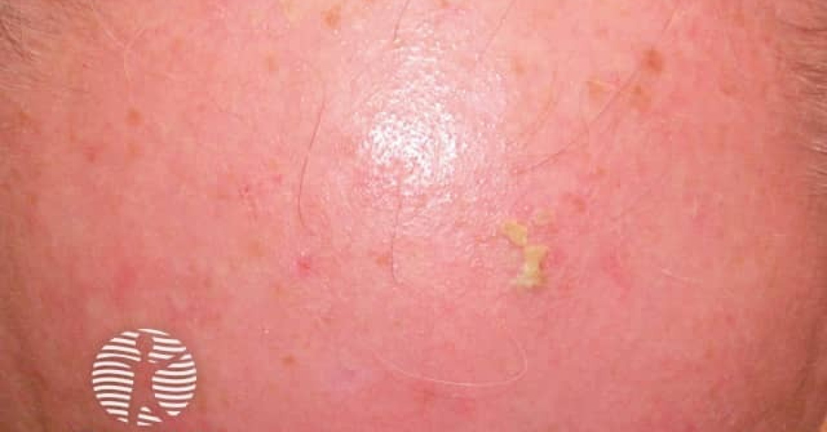 Actinic keratoses affecting the scalp image