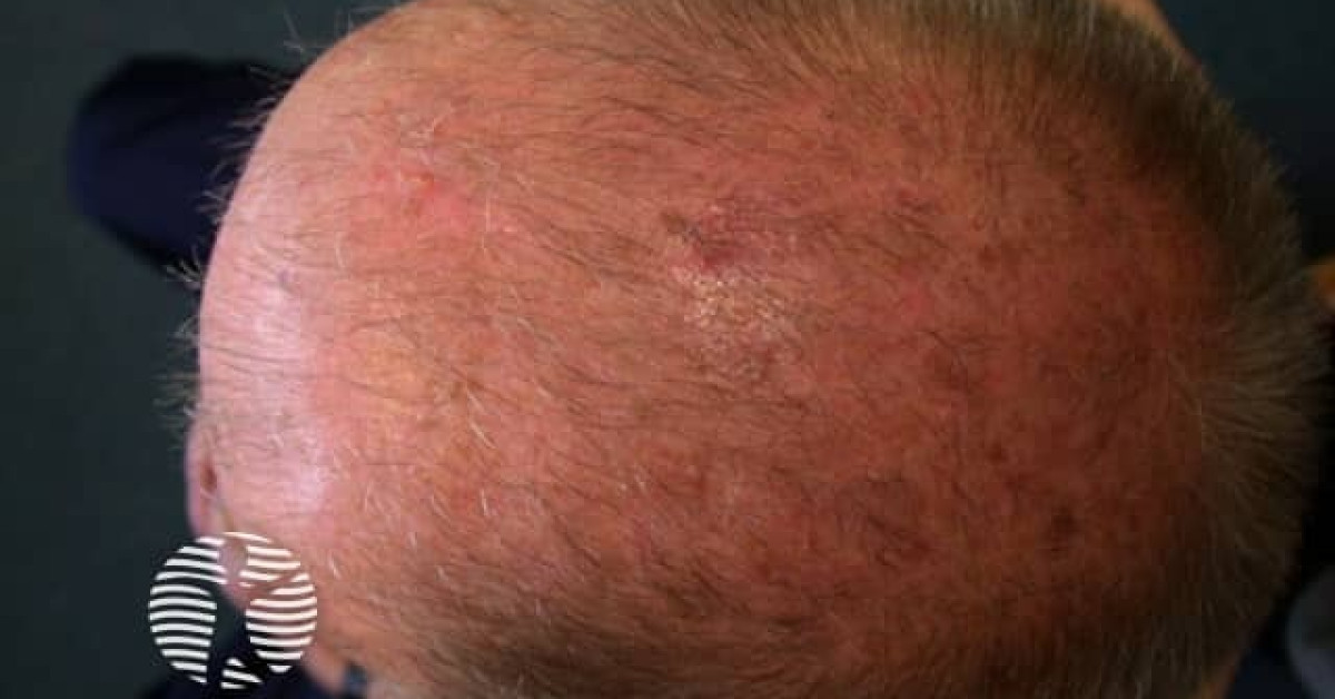 Actinic keratoses affecting the scalp image