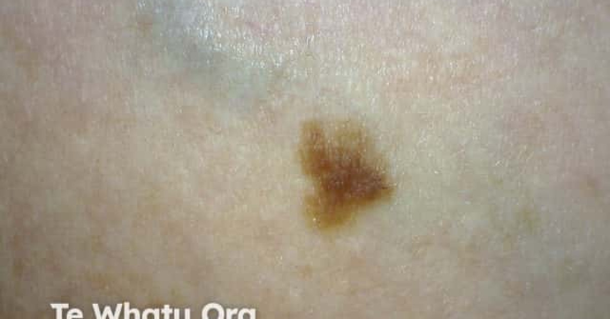 Atypical naevus image