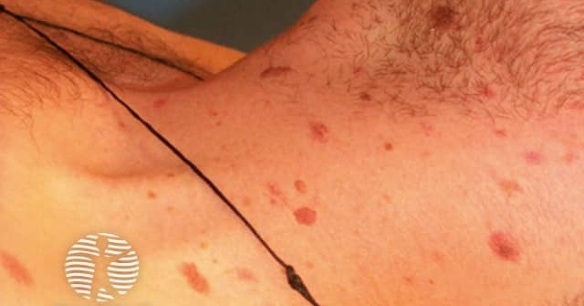 DermNet® - Atypical naevi image