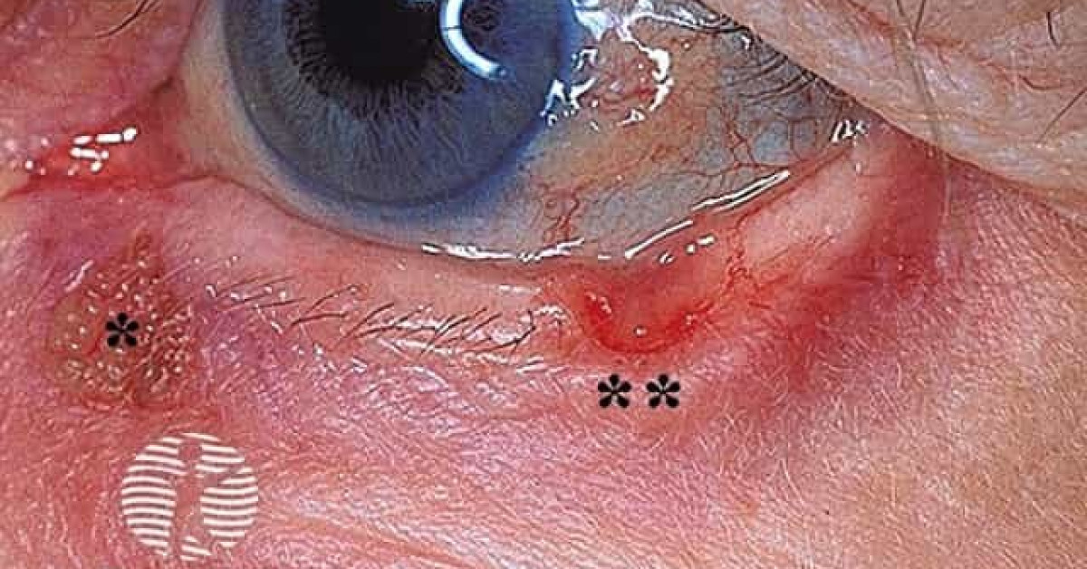 Basal cell carcinoma affecting the eyelid image