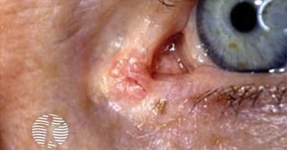 Basal cell carcinoma affecting the eyelid image