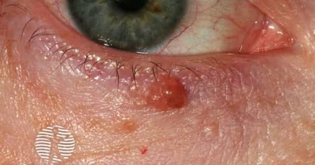 Basal cell carcinoma affecting the eyelid image