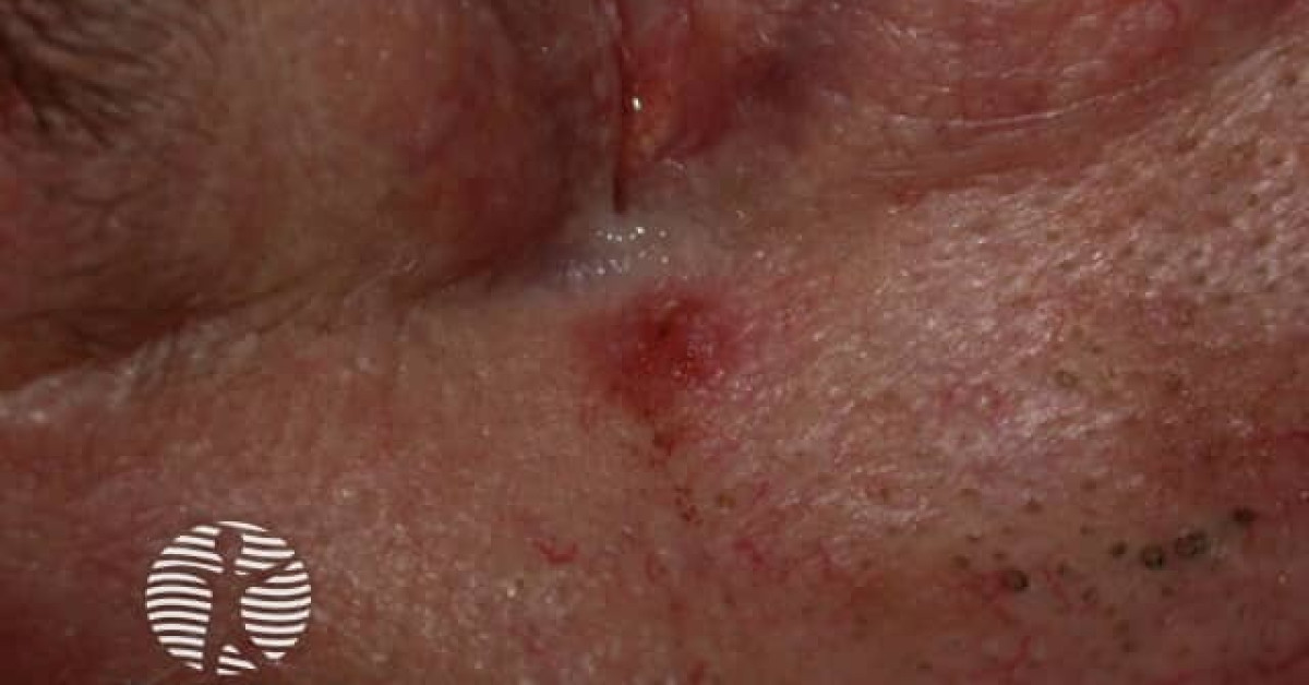 Basal cell carcinoma affecting the eyelid image