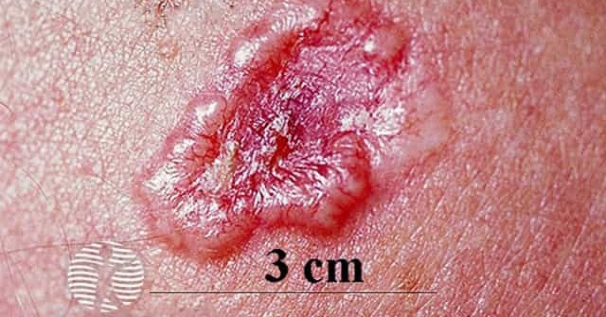 Basal cell carcinoma affecting the face image