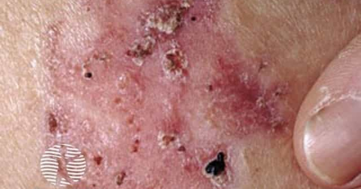 Basal cell carcinoma affecting the face image