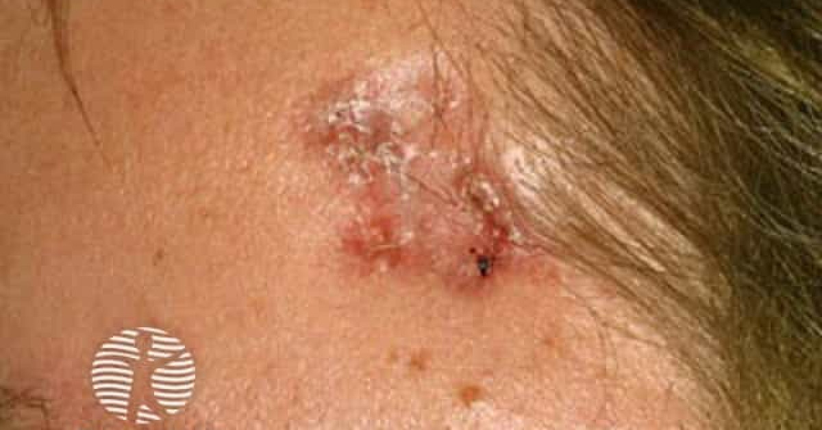 DermNet® - Basal cell carcinoma affecting the face image