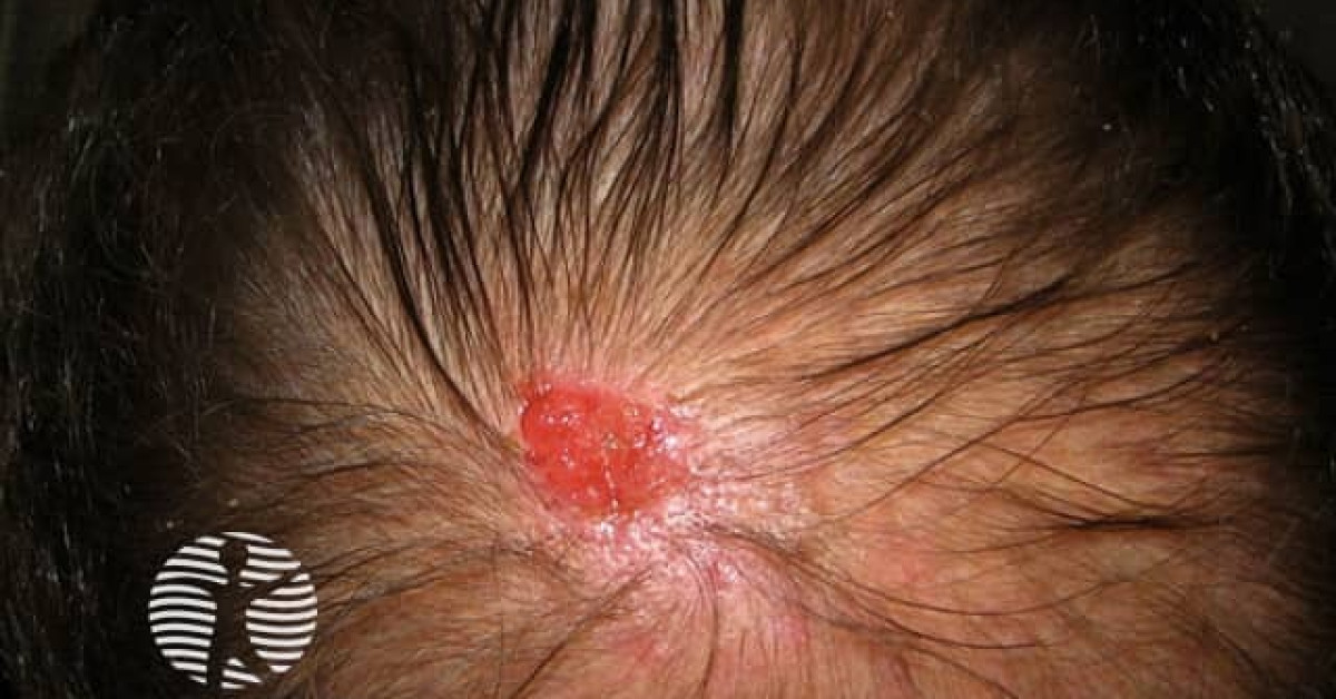Basal cell carcinoma affecting the face image