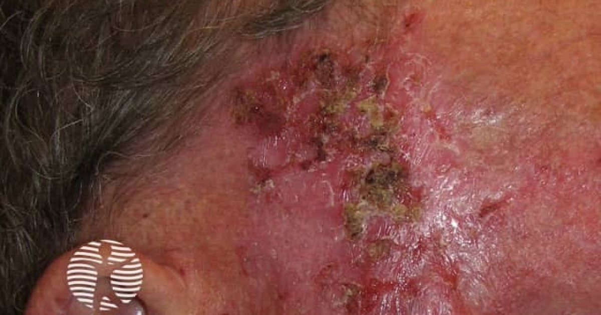 Basal cell carcinoma affecting the face image