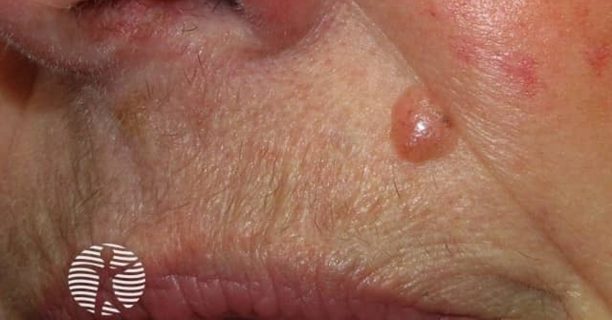 Basal cell carcinoma affecting the face image