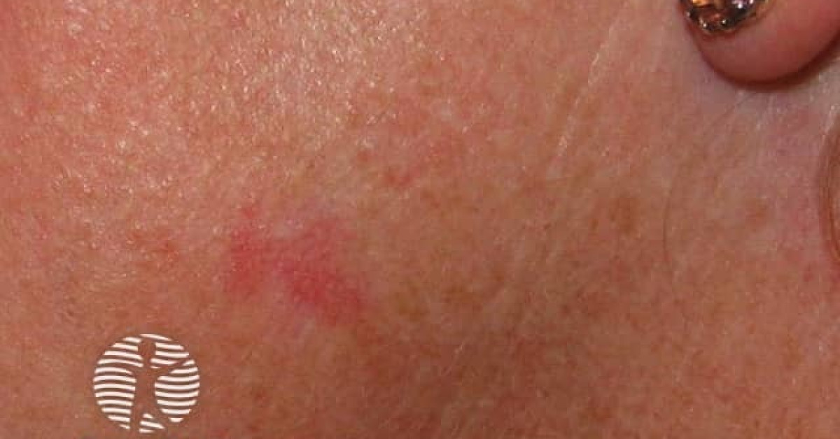 Basal cell carcinoma affecting the face image