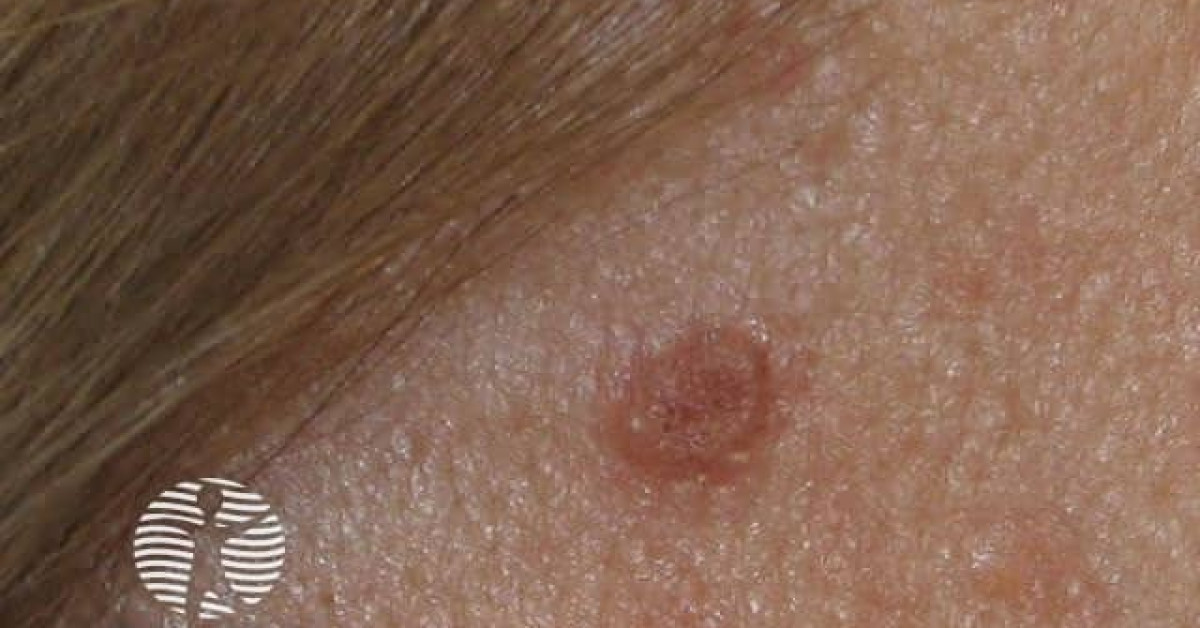 Basal cell carcinoma affecting the face image