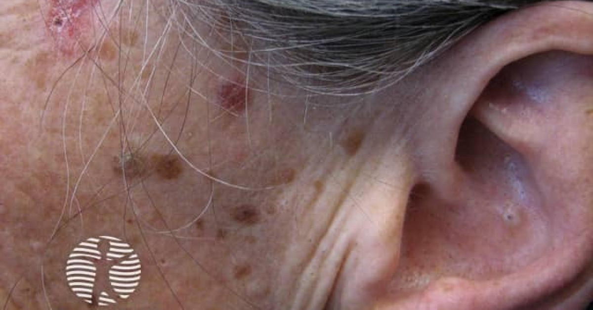 Basal cell carcinoma affecting the face image