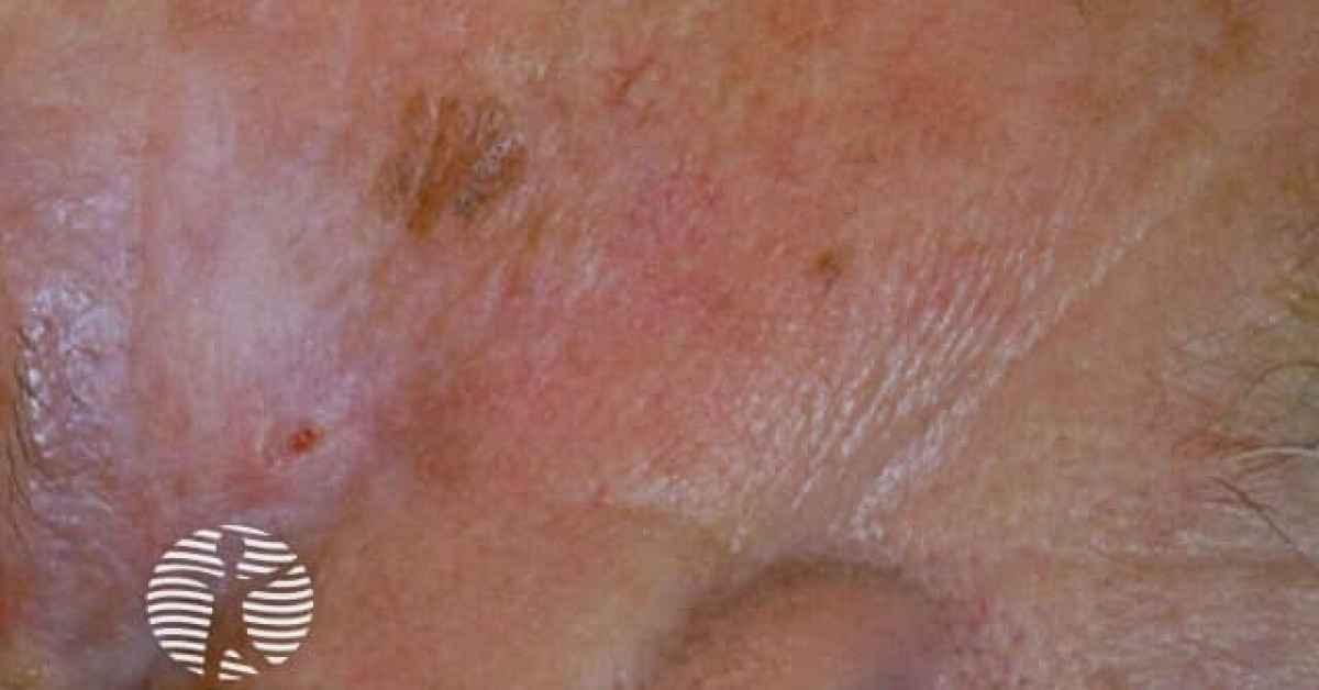 Basal cell carcinoma affecting the face image