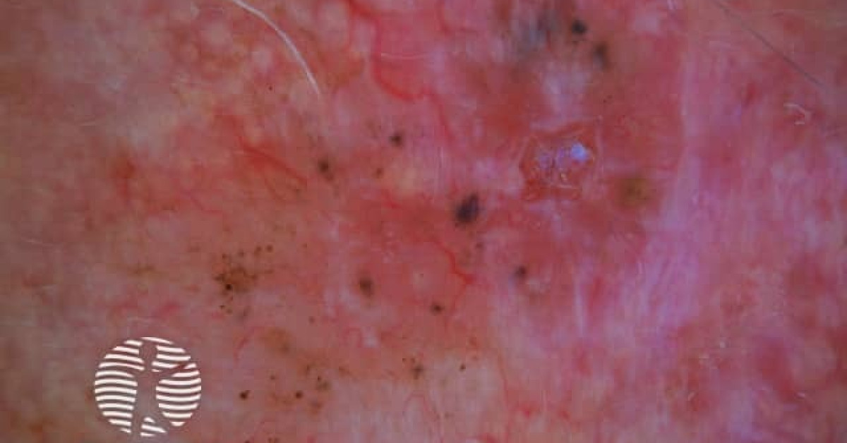 Basal cell carcinoma affecting the face image