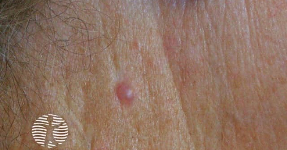 Basal cell carcinoma affecting the face image