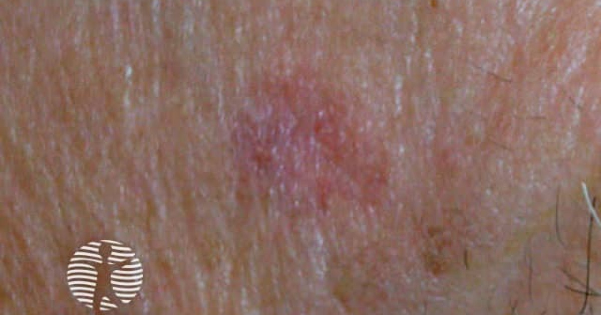 Basal cell carcinoma affecting the face image