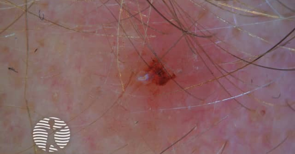 Basal cell carcinoma affecting the face image