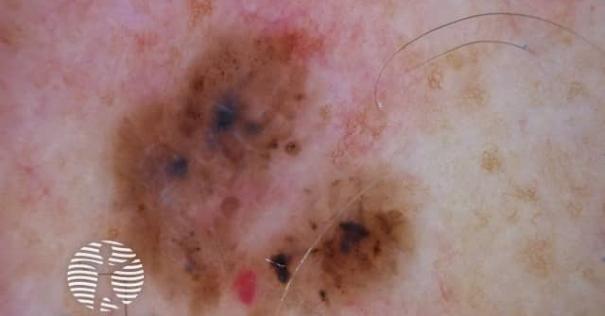 Basal cell carcinoma affecting the face image