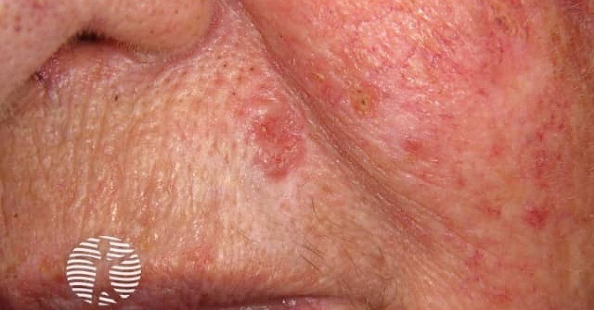 Basal cell carcinoma affecting the face image