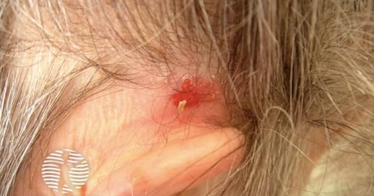 Basal cell carcinoma affecting the face image