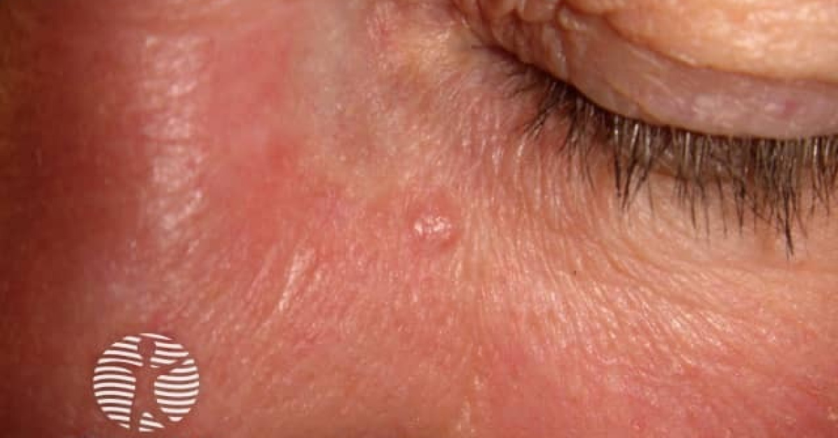 Basal cell carcinoma affecting the face image