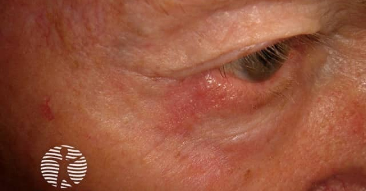 Basal cell carcinoma affecting the face image