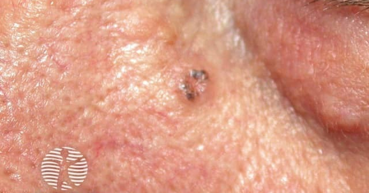Basal cell carcinoma affecting the face image
