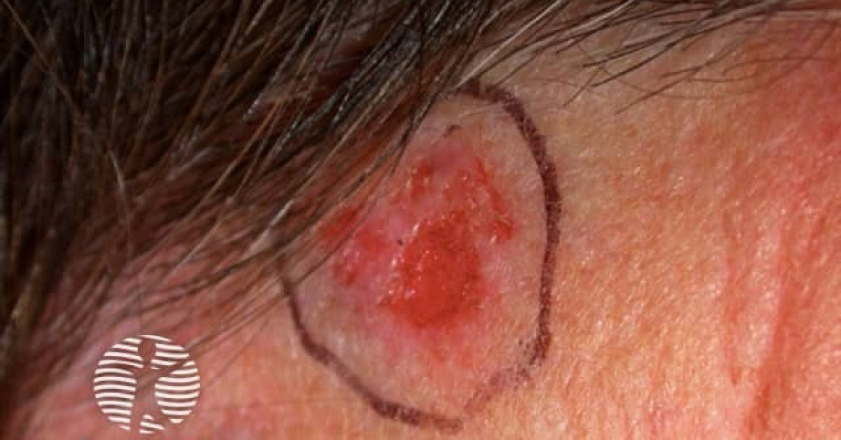 Basal cell carcinoma affecting the face image