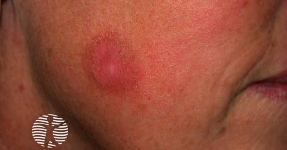 Basal cell carcinoma affecting the face image