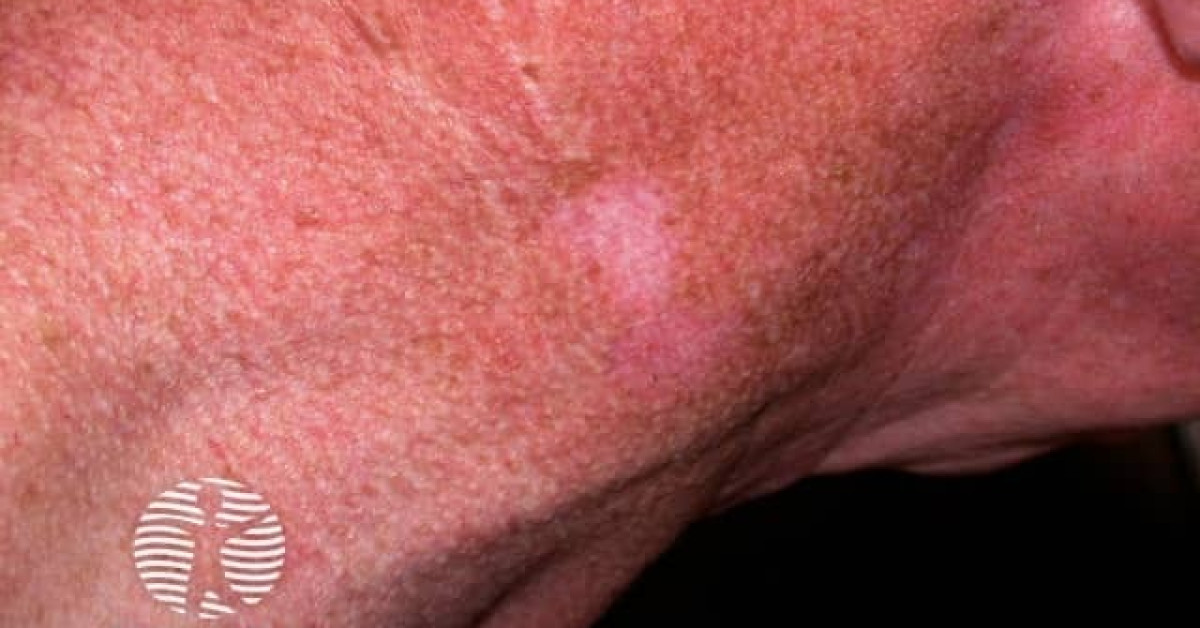 Basal cell carcinoma affecting the face image