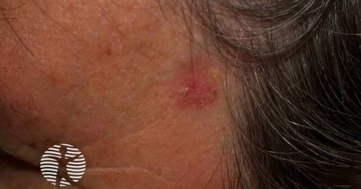 Basal cell carcinoma affecting the face image