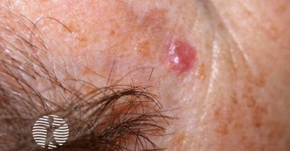 Basal cell carcinoma affecting the face image