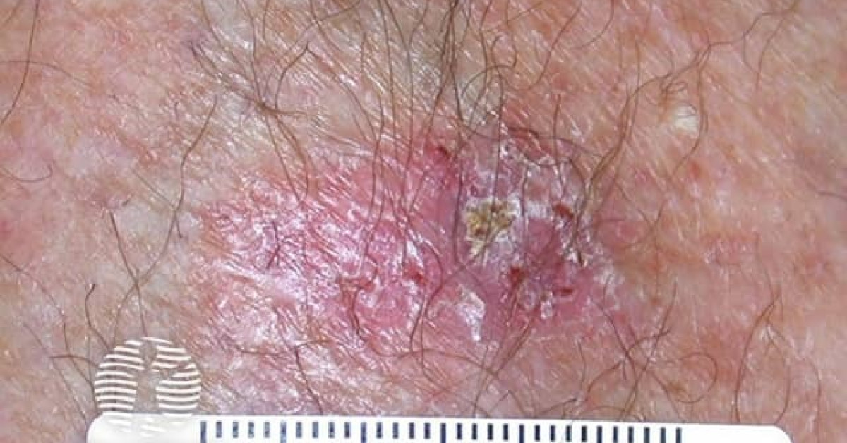 Basal cell carcinoma affecting the face image