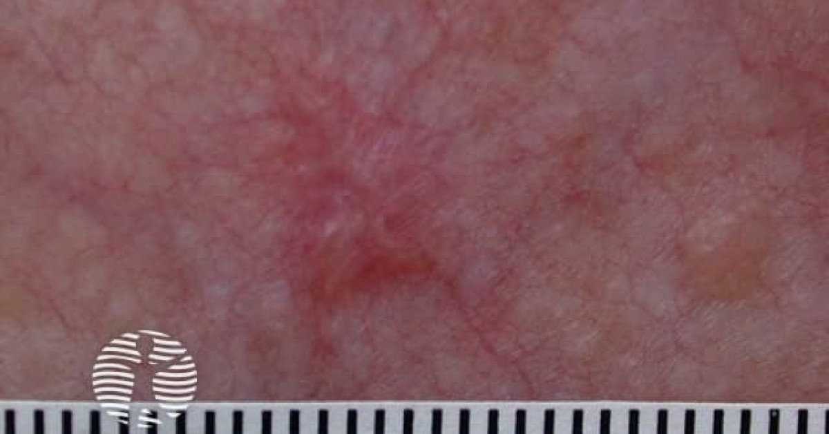 Basal cell carcinoma affecting the face image