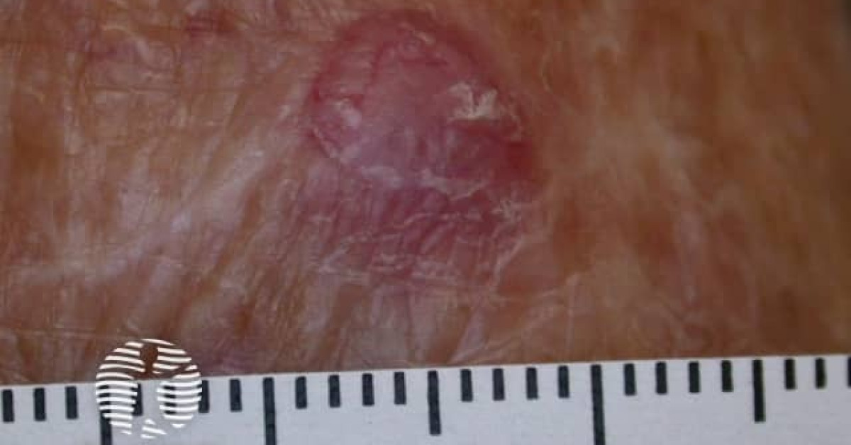 Basal cell carcinoma affecting the face image