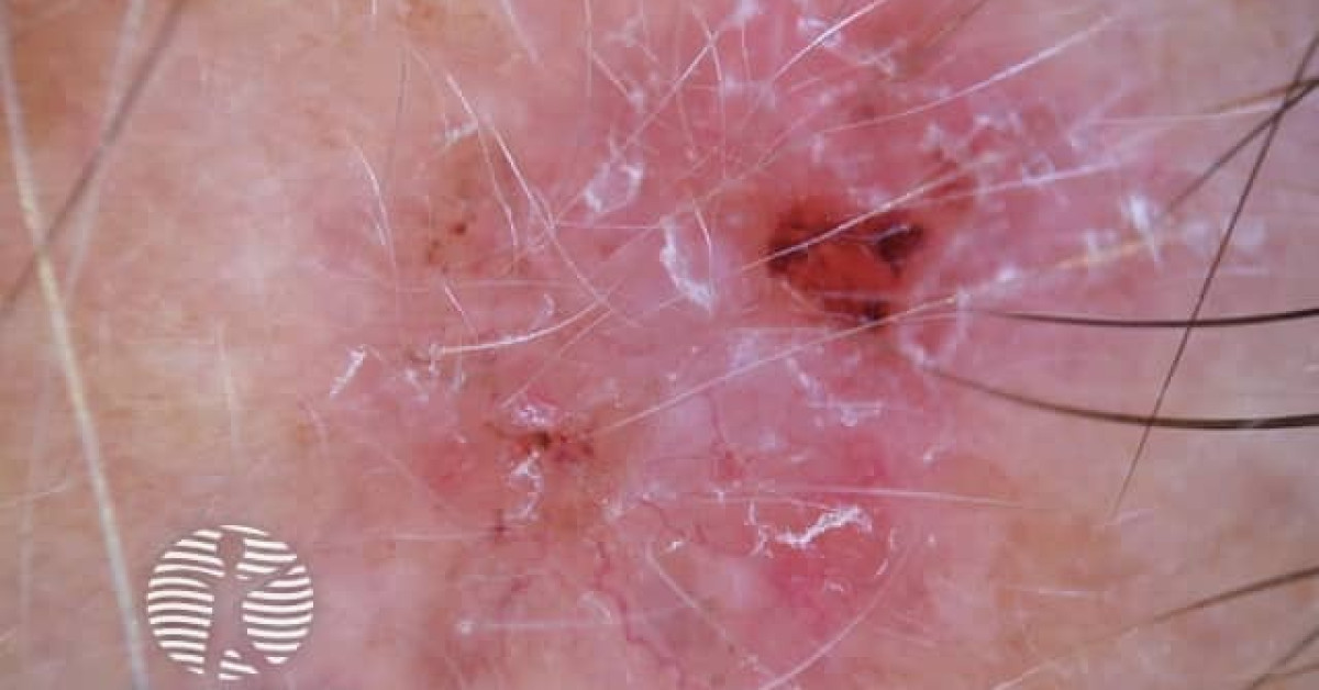 Basal cell carcinoma affecting the face image