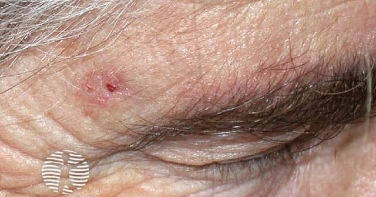 Basal cell carcinoma affecting the face image