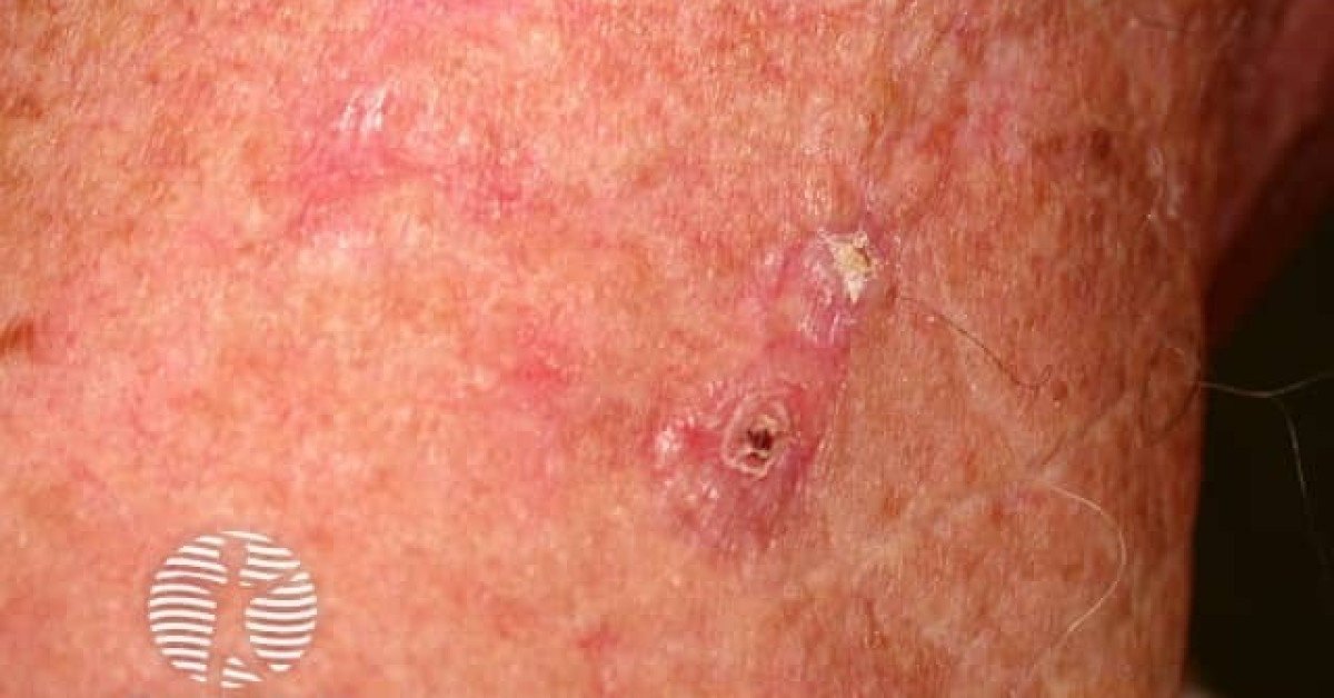 Basal cell carcinoma affecting the face image