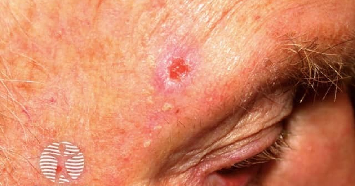 Basal cell carcinoma affecting the face image