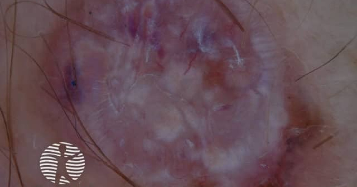 Basal cell carcinoma affecting the face image