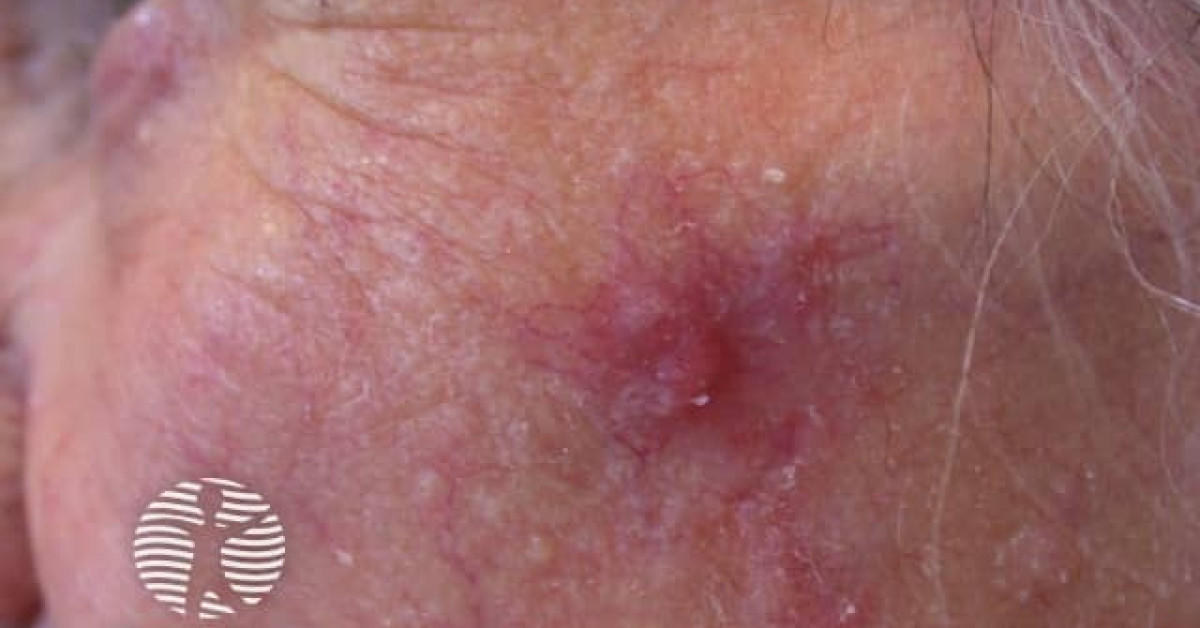 Basal cell carcinoma affecting the face image