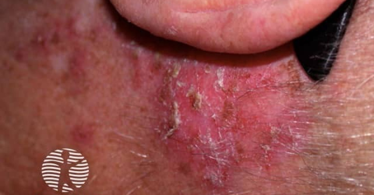 Basal cell carcinoma affecting the face image