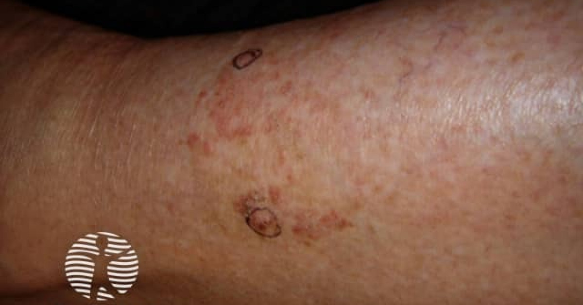 Basal cell carcinoma affecting the arms and legs image