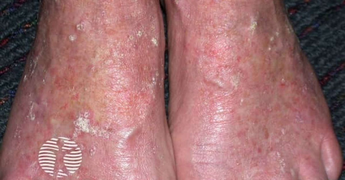 Basal cell carcinoma affecting the arms and legs image