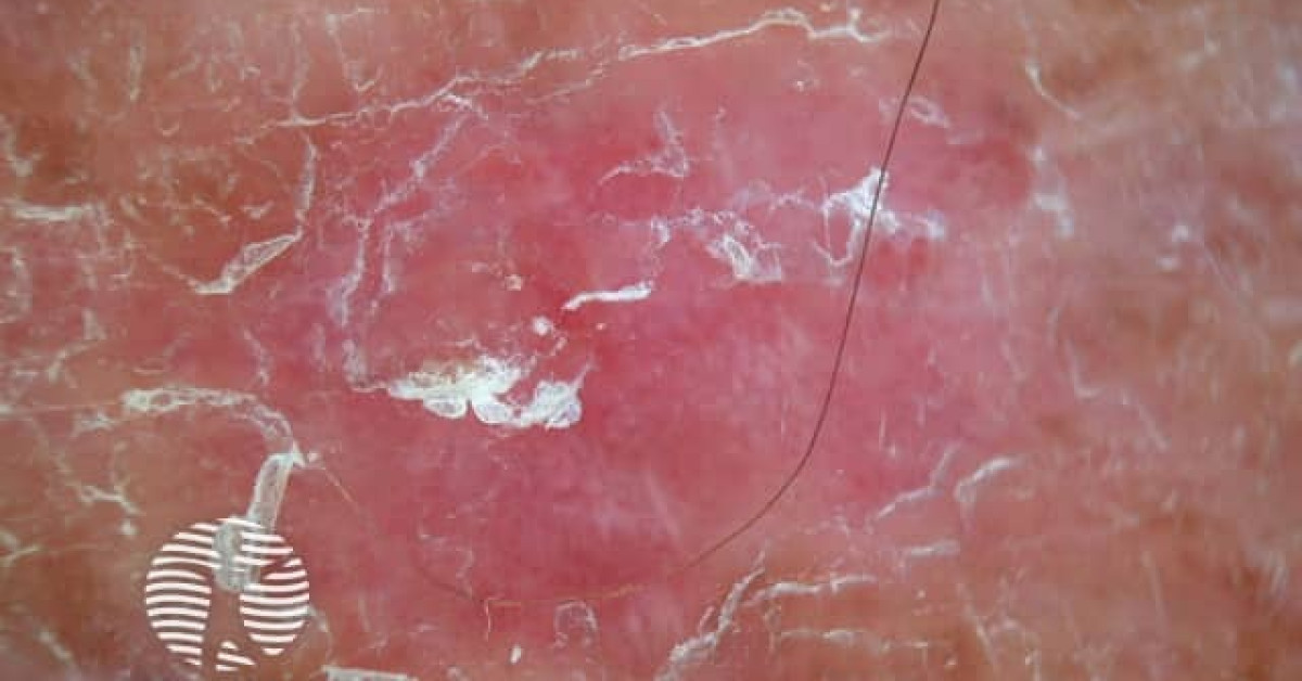 Basal cell carcinoma affecting the arms and legs image