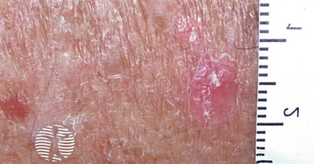Basal cell carcinoma affecting the arms and legs image