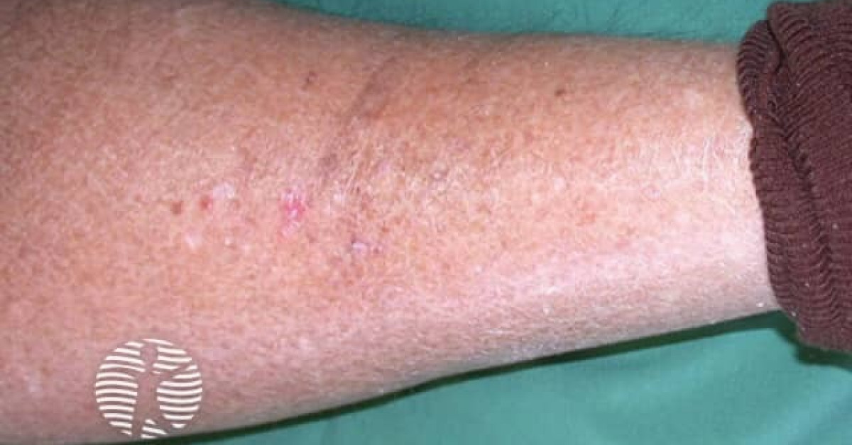 Basal cell carcinoma affecting the arms and legs image