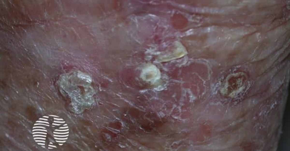 Basal cell carcinoma affecting the arms and legs image