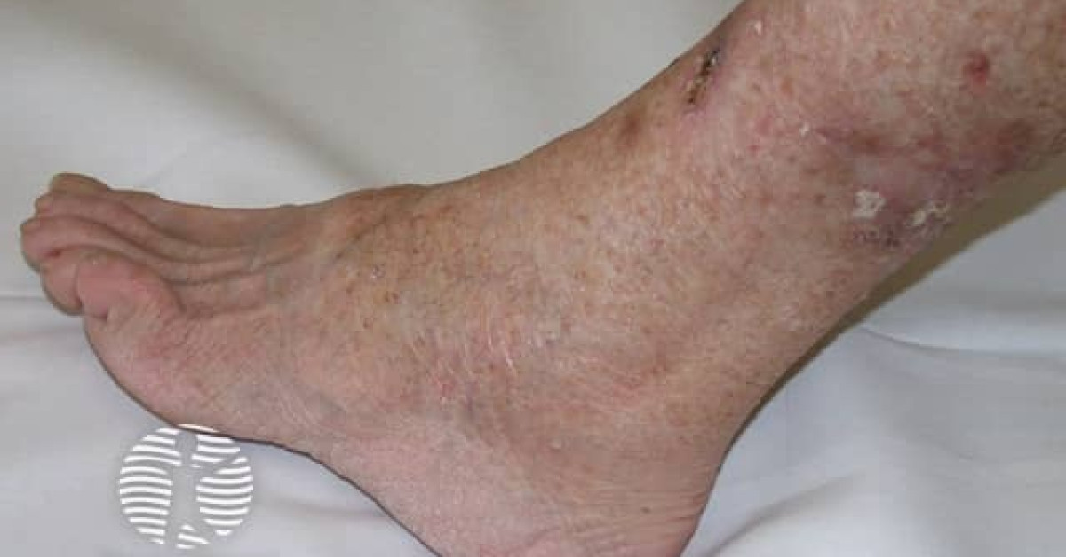Basal cell carcinoma affecting the arms and legs image